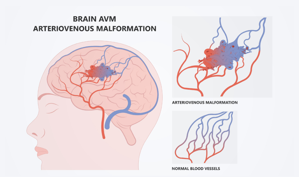 Cerebral Arteriovenous Malformation (AVM) is a serious danger ...